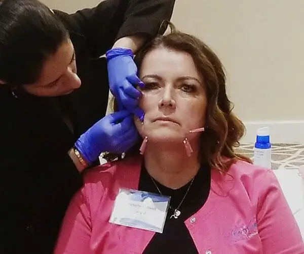 Achieve a Defined Jawline: Thread Lift for Double Chin